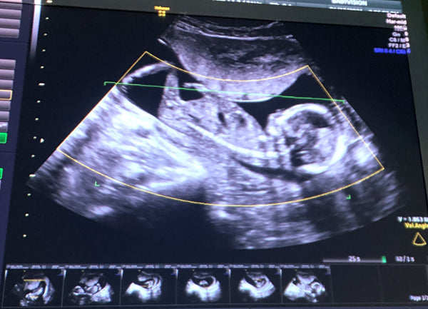 Busy Lives Made TTC Baby #2 a Challenge They Met With Mosie - Mosie Baby